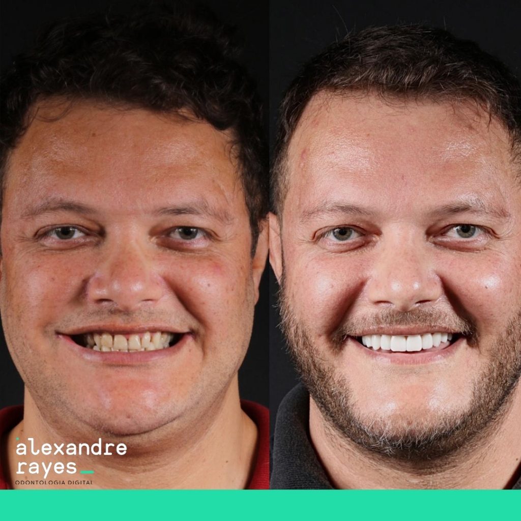 Implantes Dentários com o Dr. Alexandre Rayes | ALEXANDRE RAYES