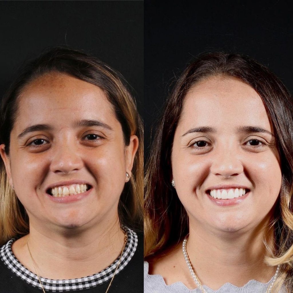 Implantes Dentários com o Dr. Alexandre Rayes | ALEXANDRE RAYES